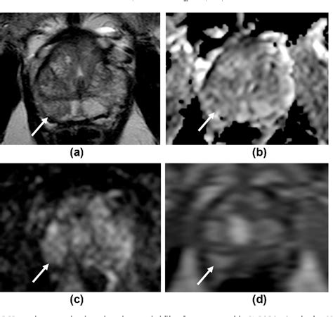 Figure 6 From Pi Rads Version 2 What You Need To Know Semantic Scholar