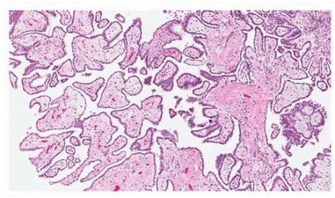 Mesothelioma Of The Pleura Thoracic Key