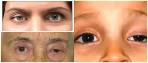 Ptosis Palpebral Tipos Síntomas Causas Factores De Riesgo