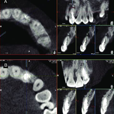Preoperative Cone Beam Computed Cross Sections Notice Apical Fracture