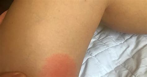 Rash Album On Imgur