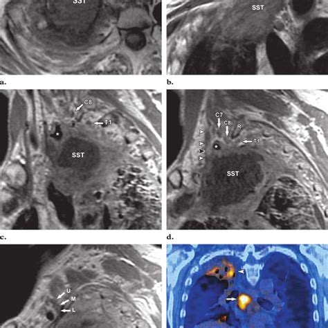 Respiratory Motion Artifact A Axial T1 Weighted Mr Image Acquired Download Scientific