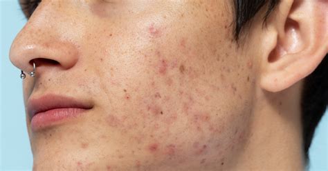 Acne Vs Acne Scars Understanding The Difference AndSons SG