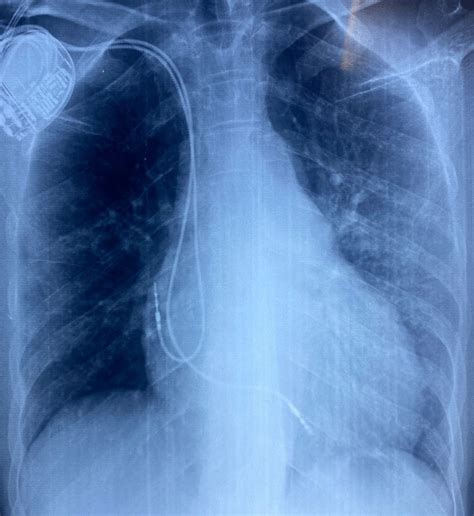 A Transvenous Dual Chamber Permanent Pacemaker Implanted Through The