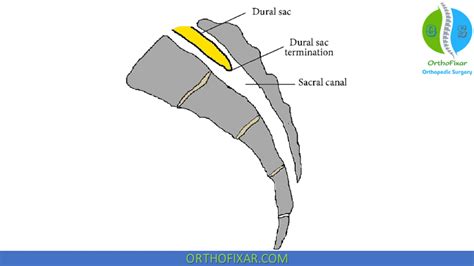 Caudal Epidural Injection Overview Orthofixar 2025