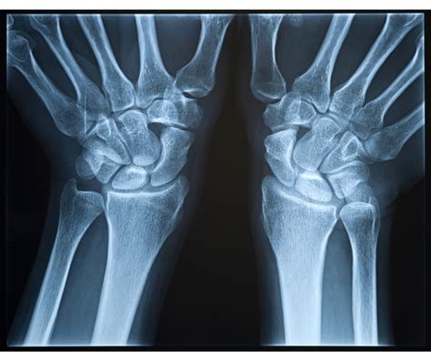 Signs Of Wrist Fracture After A Car Accident Law Offices Of Gary