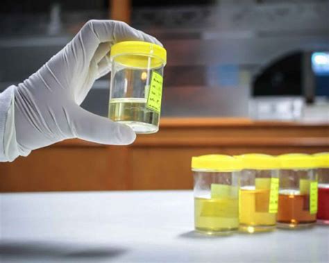 Sterile Pyuria A Diagnostic Challenge