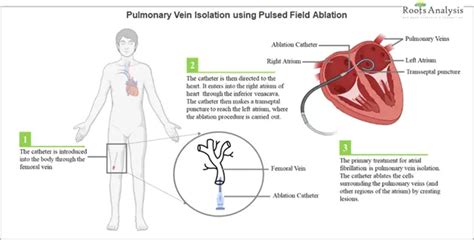 Pulsed Field Ablation