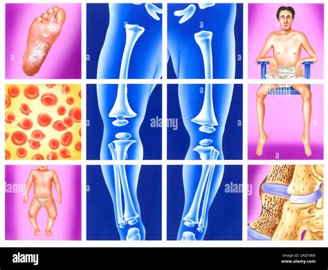 Los Síntomas De Deficiencia De La Vitamina Ilustración De Síntomas Que