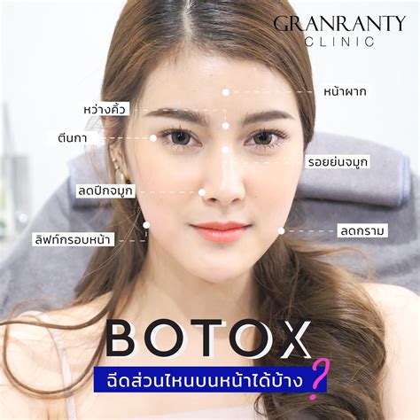 Botox ฉีดส่วนไหนบนหน้าได้บ้าง 👩🏻 💜 หน้าผาก ริ้วรอยบนหน้าผาก ที่เกิด