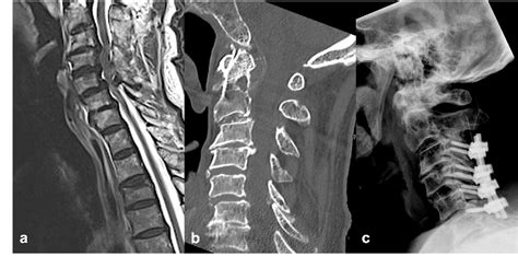 Figure 1 From Anterior Cervical Discectomy Fusion Versus Posterior