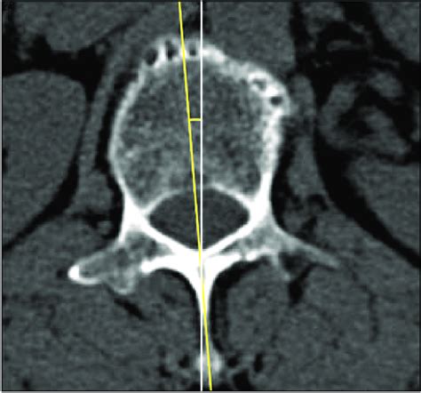 Measurement Of The Vertebral Rotation Angle Defined As The Angle Download Scientific Diagram