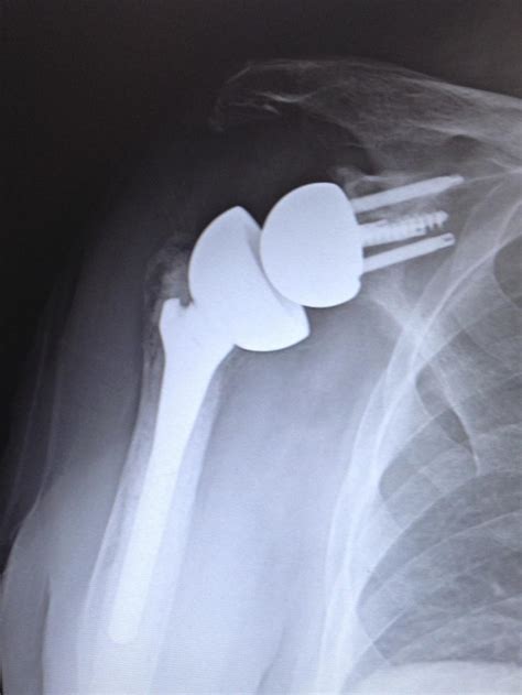 Shoulder Replacement Surgery Questions To Ask Thomas Joseph Kovack Do