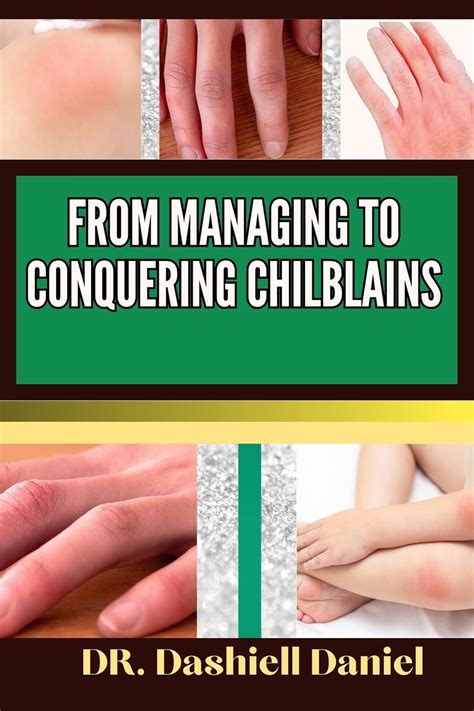From Managing To Conquering Chilblains Navigating Frosty Ailments For