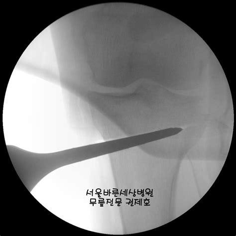 근위경골절골술 연골판파열 미세천공술 연골재생과 휜다리 교정하는 제이본정형외과 권제호 네이버 블로그