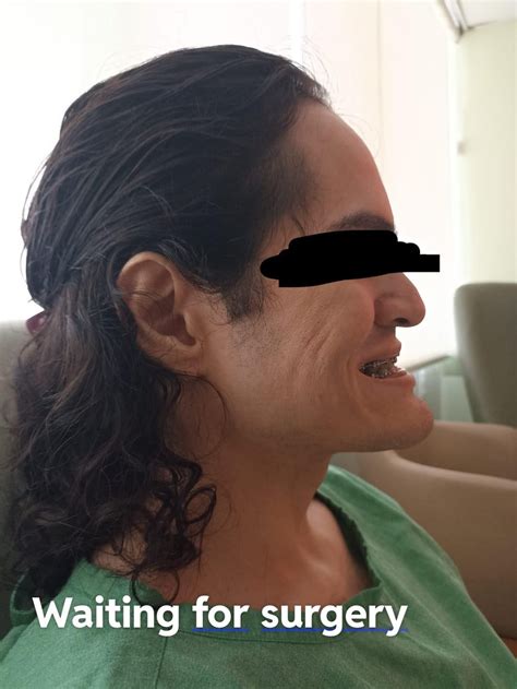 Djw Class 3 Underbite My First Week Rjawsurgery