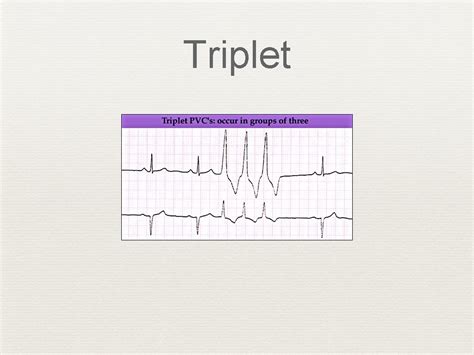 Ecg Interpretation Criteria Review Axis Deviation Left Right