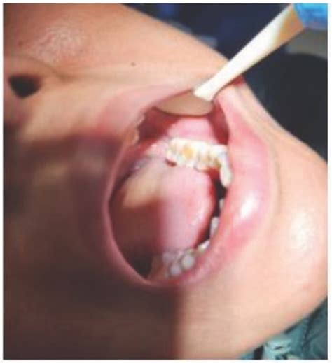 Coronectomy A Case Report Following Coronectomy Of A ‘high Risk