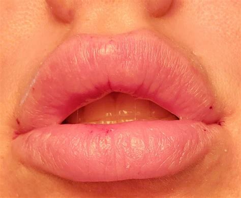 Juvederm Ultra Xc Beauty Inspiration Juvederm Beauty