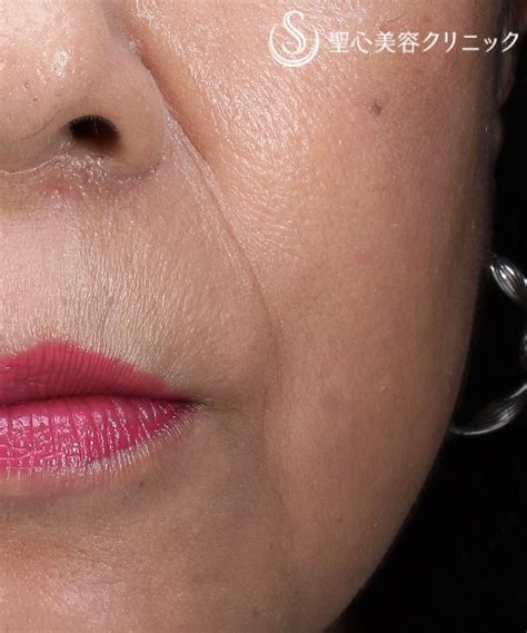 【60代女性・法令線、マリオネットライン】プレミアムprp皮膚再生療法（visia評価）（1年10ヶ月後） 症例写真 美容整形、美容