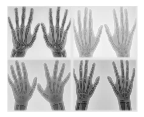 Bone Age Assessment Resources