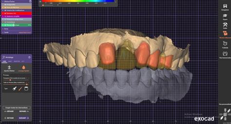 Exocad Dentaldesign Aesthetics Cadcam Mohamed Amine Hamdi