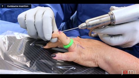 Arthrodesis Of The Distal Interphalangeal Dip Joint Of The Right Ring