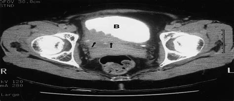 Pseudotumor Of The Bladder As A Manifestation Of Uncomplicat Journal Of Clinical