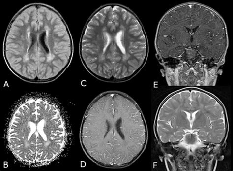 A Axial Flair Weighted Image Shows Posterior Periventricular