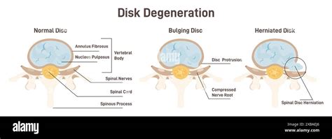 Disc Degeneration Stages Set Flat Spine Vertebrae Anatomy Scheme