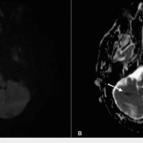 Diffusion Weighted Mri A And Adc Map B Shows Focus Of Diffusion