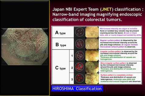 Jnet Classification Colon Explorer
