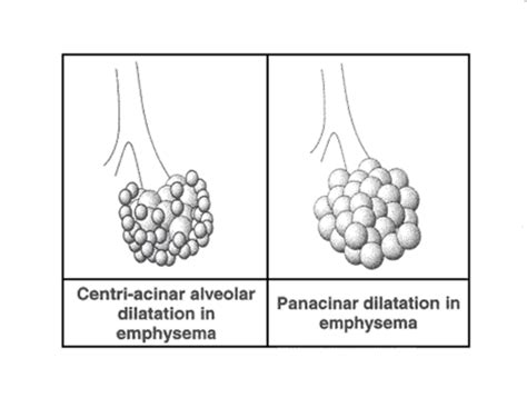 Lung Pathology Obstructive Lung Diseases Flashcards Quizlet