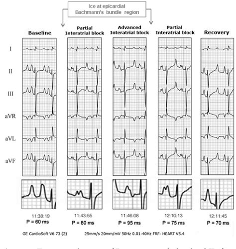 Figure 1 From Current Ecg Aspects Of Interatrial Block Semantic Scholar