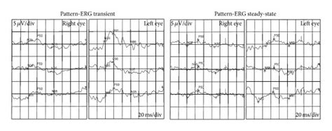 A Pattern Electroretinography Showing Delayed P50 And N95 Implicit Download Scientific