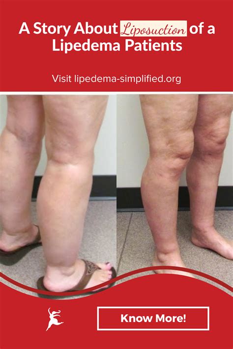 Patient Guide To Self Diagnosing Lipedema And Lipo Lymphedema Artofit