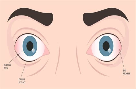 Orbital Pseudotumor
