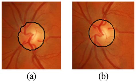 Localization And Segmentation Of Optic Disc In Retinal Images Using