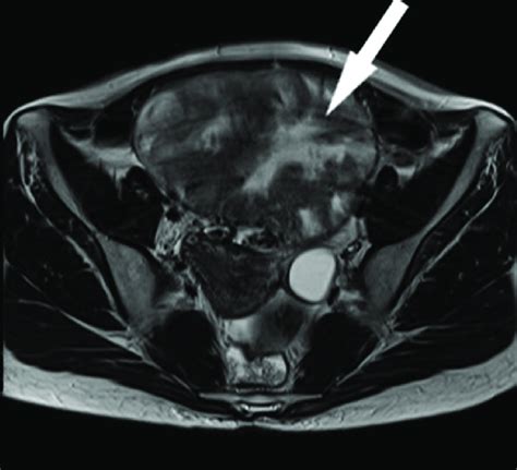 Magnetic Resonance Imaging Of The Abdomen And Pelvis T2 Weighted Signal