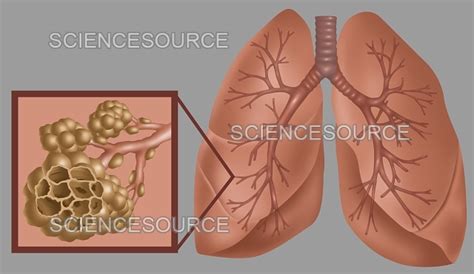 Lungs With Emphysema