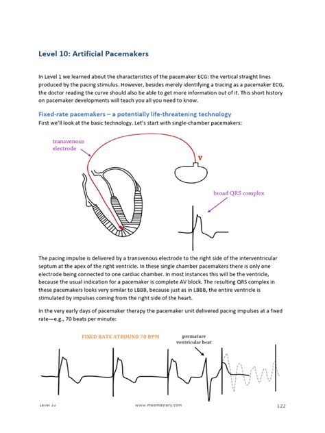 Pacemakers Fact Sheet Pdf Artificial Cardiac Pacemaker Atrium Heart