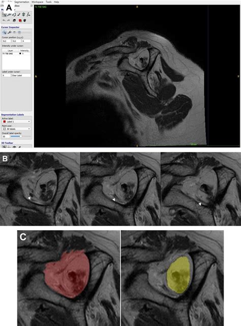 Annotation Using Itk Snap Software A Loading The Mr Image Of Oblique Download Scientific