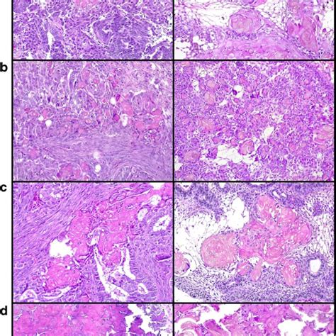 Ghost Cell Keratinization In Endometrioid Carcinoma With Morular Download Scientific Diagram