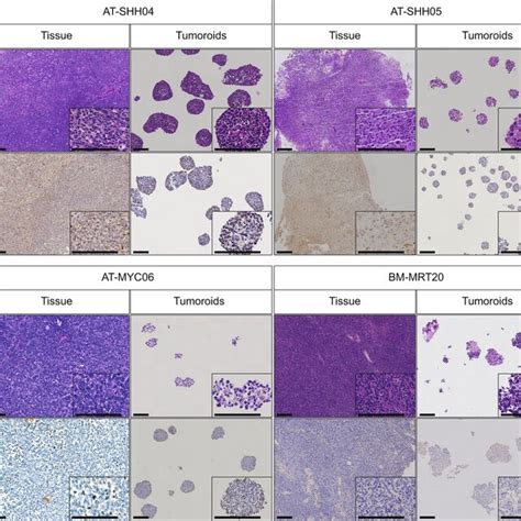 Immunohistochemical Characterization Of Atrt Tumoroid Models Hande And