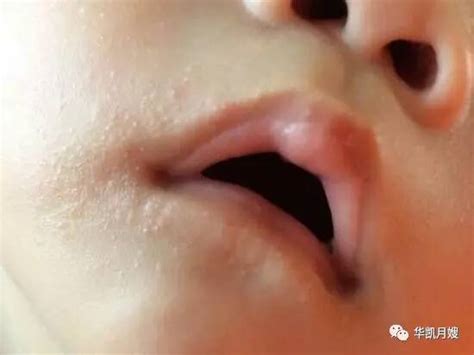 晒热疹 子热疹图片 婴儿热疹 大山谷图库