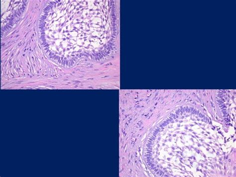 Odontogenic Tumors Ppt Pptx
