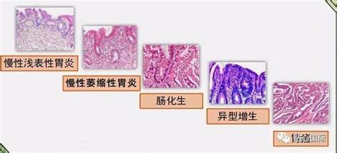 贴心医生胃癌和胃溃疡的早期特征相似如何区分胃镜活检告诉你 病变 炎症 上皮