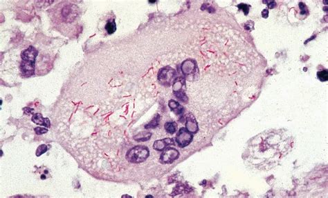 Rocky Mountain Spotted Fever Rickettsia Igenex Tick Talk