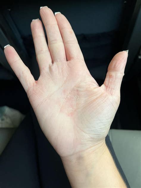 Ringworm Rdermatology