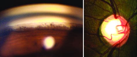 A Gonioscopy Od Showing Elongated Ciliary Process With Anterior